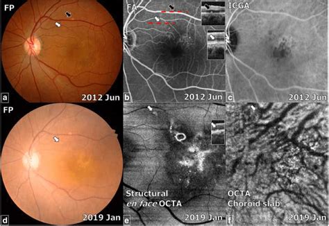 Appearance Of New Drusen In An Eye With Pachychoroid Neovasculopathy