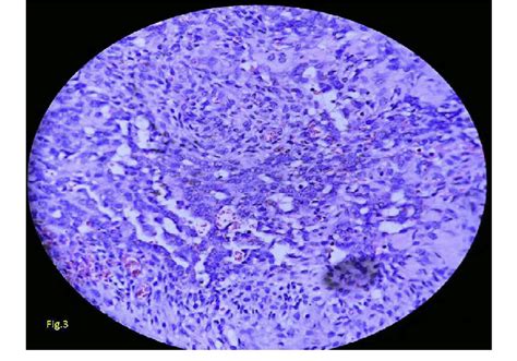 Histopathology Picture Showing Biphasic Pattern Of Synovial Sarcoma