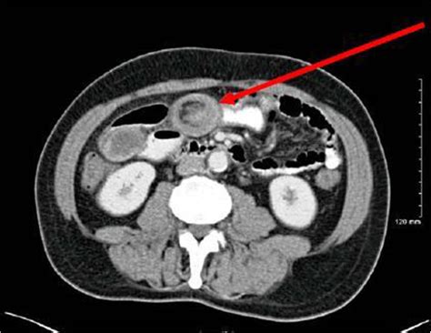Intussusception Concise Medical Knowledge