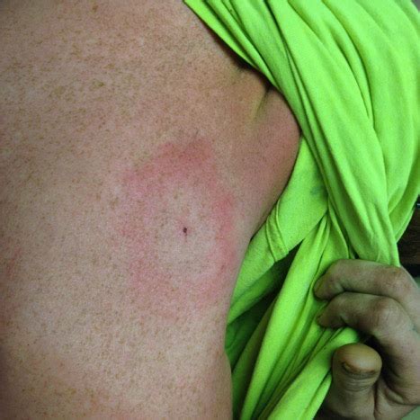 Erythema Migrans JETem