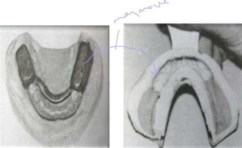 Pros Ii 14 Impression And Occlusion In Rpd Quizlet