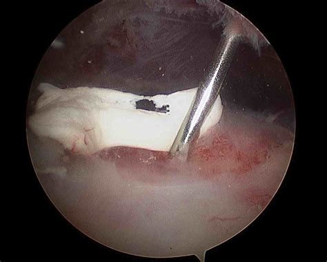 Calcific Tendinitis St Georges Shoulder Unit