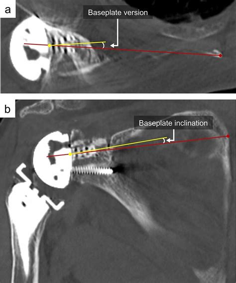 Measurement Of Glenoid Component Alignment Including Version And Download Scientific Diagram