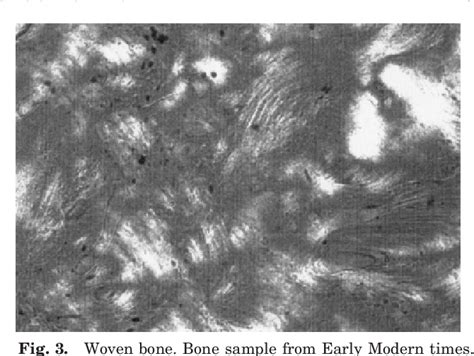 Hyperostosis Of Skull Semantic Scholar