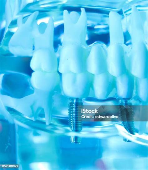 Dentsts 치과 보 철 치아 잇 몸 뿌리 교육 학생 모델 티타늄 금속 임 플 란 트 나사 건강관리와 의술에 대한 스톡 사진 및 기타 이미지 Istock