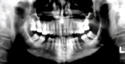 Panoramic Errors Flashcards Quizlet