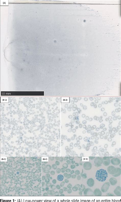 Figure 1 From Image Analysis Using Machine Learning For Automated Detection Of Hemoglobin H