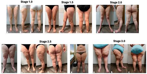 New Characterization Of Lipedema Stages Focus On Pain Water Fat And