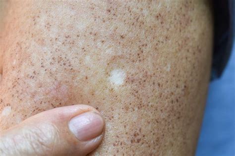 Diseases And Disorders