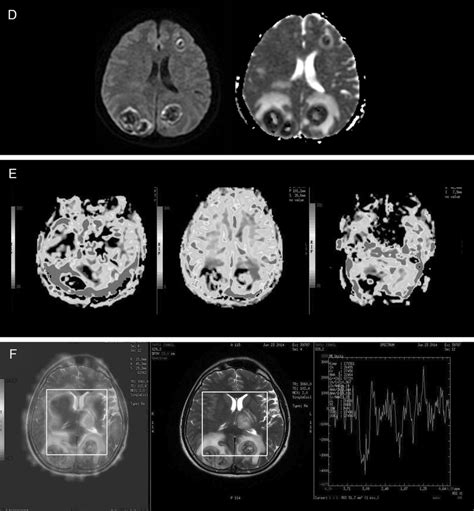 D Diffusion Magnetic Resonance Imaging Showing Restricted Peripheral Download Scientific