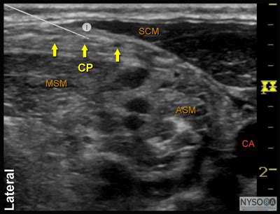 Ultrasound Guided Superficial Cervical Plexus Block NYSORA The New York Babe Of Regional