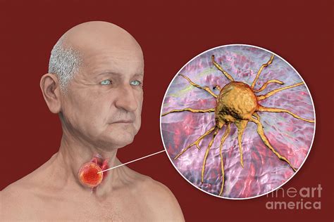 Thyroid Gland Cancer Photograph By Kateryna Konscience Photo Library