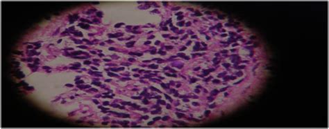 Primary Intraspinal Primitive Neuroectodermal Tumor Pnet A Rare Occurrence Medcrave Online