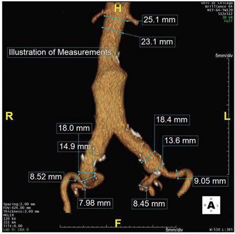 Case Planning For An Iliac Branch Endoprosthesis Procedure Endovascular Today