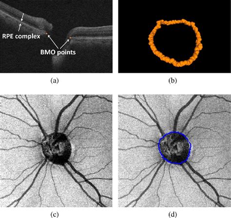 Figure 2 From Multimodal Segmentation Of Optic Disc And Cup From Sd Oct And Color Fundus