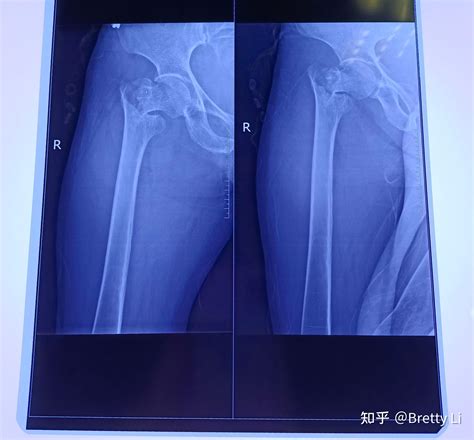 常见骨折类型X线片探讨分析2 知乎