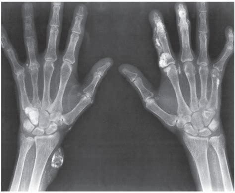 Hyperparathyroidism Radiology Key