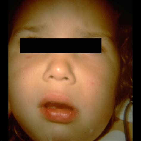 Preschooler With Stridor Sore Throat Drooling And Fever Pediatric Radiology Case Pediatric
