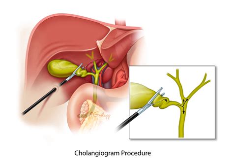 View Chriss Medical Illustrations For Medical Legal Cases Chris Gralapp MA CMI