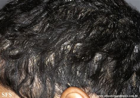 Pityriasis Amiantacea Nc Commons