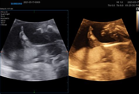 Samsung Hera W10 Elite Advmedical C A