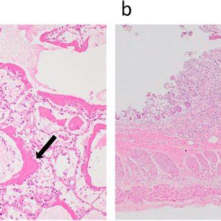 Histopathologic Findings Of Bilateral Lungs Show Diffuse Alveolar Download Scientific Diagram