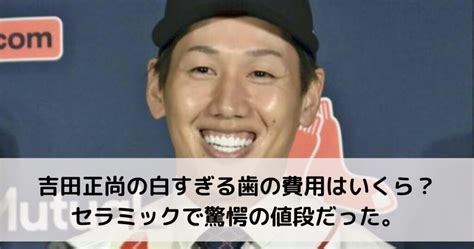 吉田正尚の白すぎる歯の費用はいくら？セラミックで驚愕の値段だった。