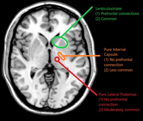 Stroke And Prefrontal Connections Stroke Maps