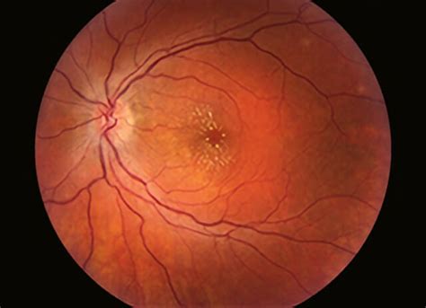 Infectious Retinitis Treatment Retinal Consultants Medical Group