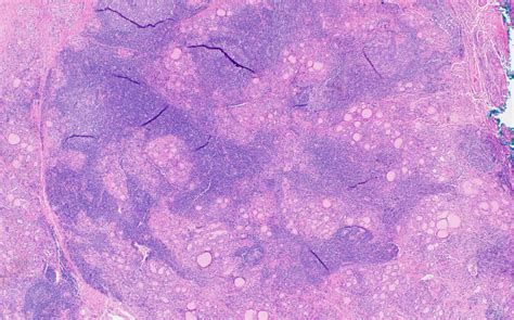 Histology Of Hashimotos Thyroiditis My Endo Consult