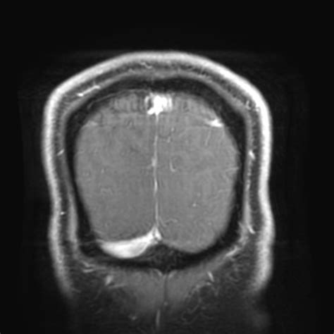 Fileastrocytoma Idh Mutant Radiopaedia 43678 47125 Coronal 41png