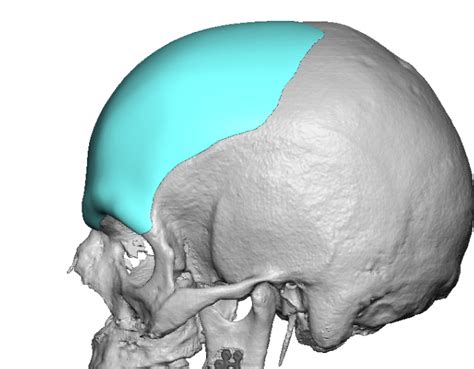 Technical Strategies Subfascial Fat Injections For Temporal