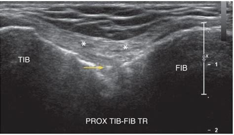 Proximal Tibiofibular Joint Injection Wikism Sports Medicine Wiki