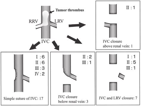 Inferior Vena Cava Repair After Tumor Thrombus Resection Showing Each Download Scientific
