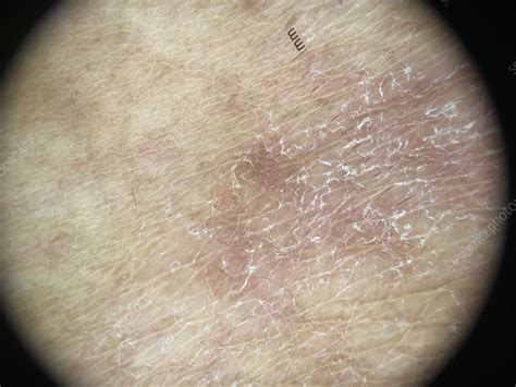 Ringworm Dermoscopy Stock Image C0603539 Science Photo Library