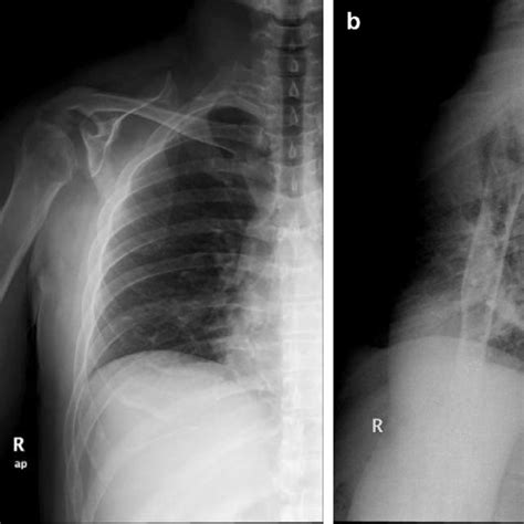 A B Post Operative Plain Ap And Lat X Rays Download Scientific