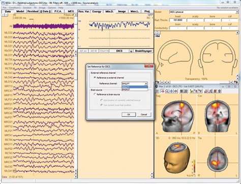 Besa® Brain Electrical Source Analysis Features Source Coherence