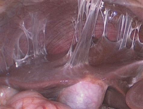 What Does Chlamydia Look Like