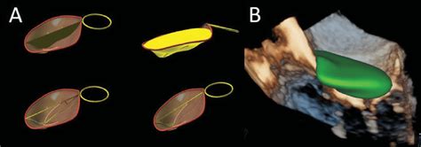 Functional Mitral Regurgitation Three Dimensional Reconstruction Of