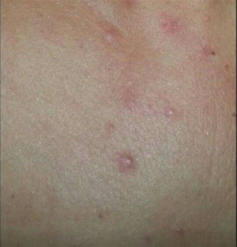 Lupus Skin Lesions From Sun
