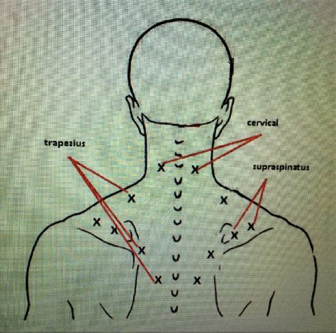 Scalenes Trigger Points