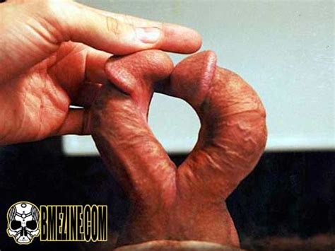 Genital Bisection BME Encyclopedia