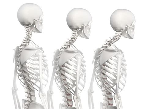 Cervical Kyphosis Understanding A Complex Spinal Condition