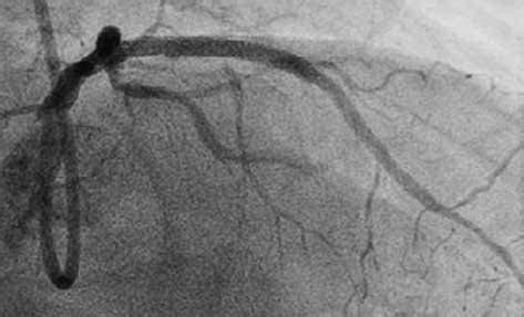 Angioplasty Of SCAD In LAD With Multiple Ectatic And Stenotic Segments Download Scientific