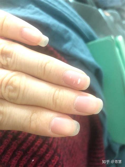 手指甲上面有白点是什么意思，正常吗？ 知乎