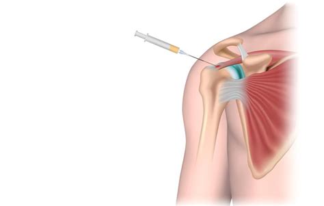Regenerative Medicine Therapy In Pune The Prolotherapy Clinic
