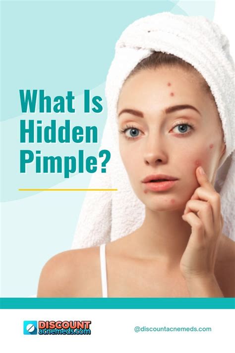 Skincare Tips To Prevent Pimples Artofit