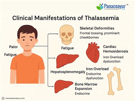 Thalassemia Treatment Symptoms Causes And Natural Approach
