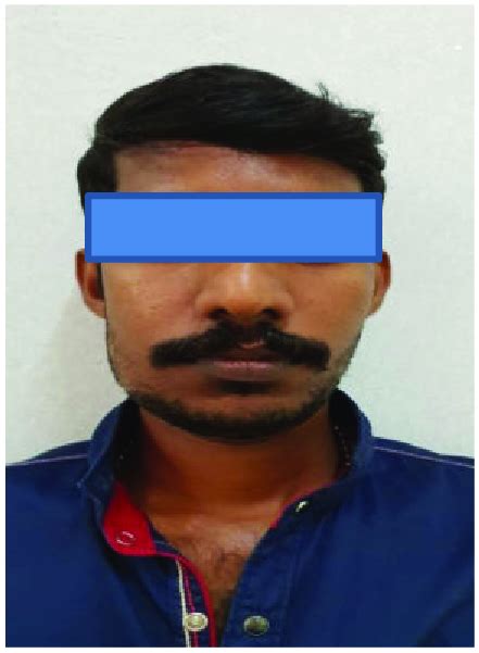 Extra Oral Photograph Of The Patient Diffuse Swelling Over The Right