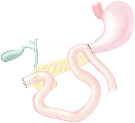 An Anastomosis Of End Of Stomach To Antimesenteric Border Of Jejunum